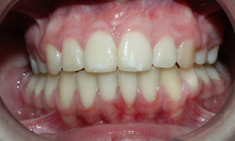 Before & After | Daub Orthodontics