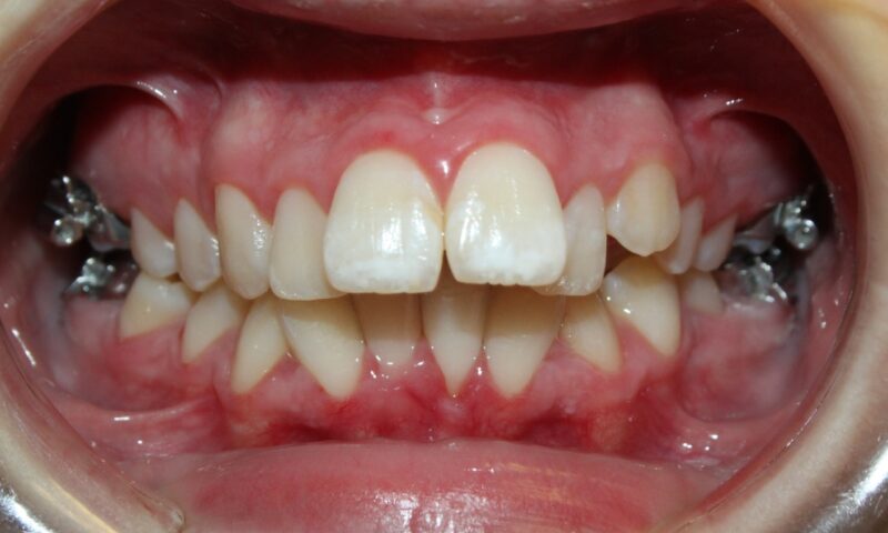 Before & After | Daub Orthodontics